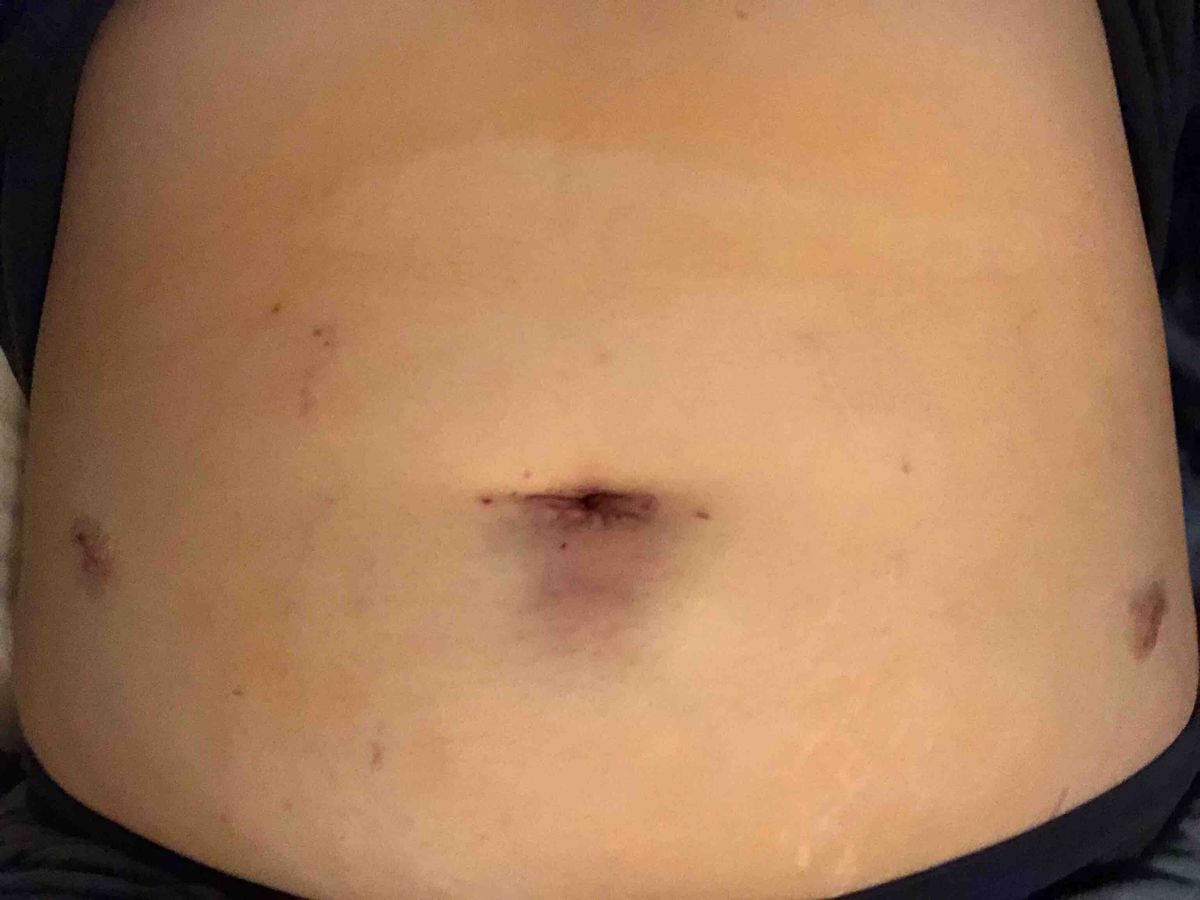 Ovarian Cyst Removal Scar