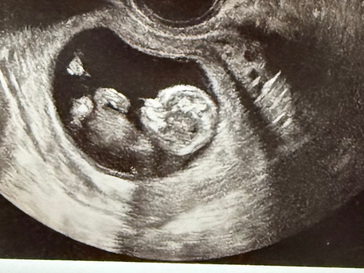 Fundraiser by erin steiner : Help Oaklynn and Family Through Heart Surgery