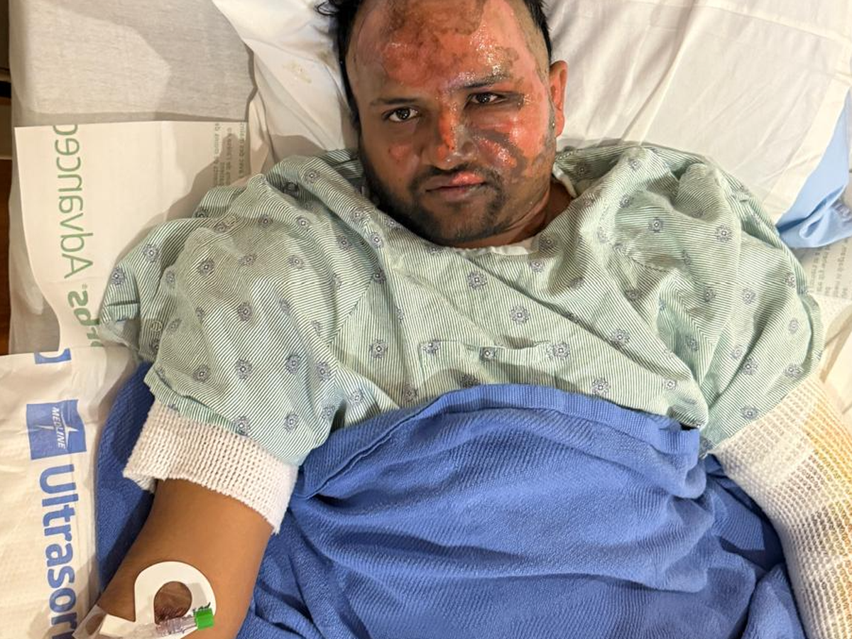 Fundraiser by Deepak Kumar D : Help Overcome Severe Burn Injuries