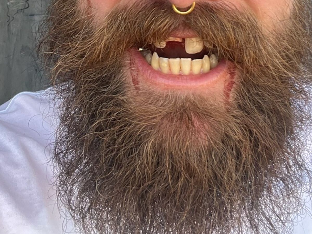 Fundraiser for Matt Bergen by Josee Bosgra : Help Fix Matt's Mouth