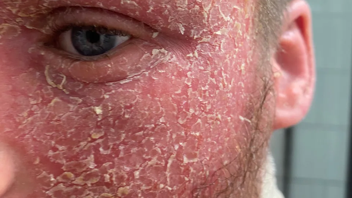 Fundraiser by Callum Hobson : Topical Steroid Withdrawal