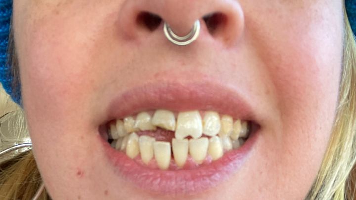 Fundraiser by Alexus Robinson : Help Alexus Fix Her Mouth