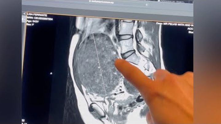 Fundraiser by Lisa Mia Ferrante : Lisa's Hysterectomy Surgery & Recovery