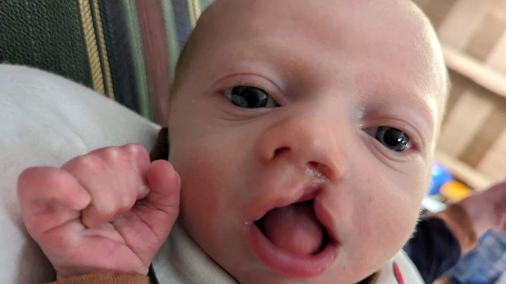 Fundraiser for Andrew Engel by Elisabeth Engel : Matthew Engel's Cleft ...
