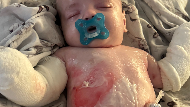 Fundraiser by Sebastiano Maiurro : Support Our Son's Fight Against EB ...