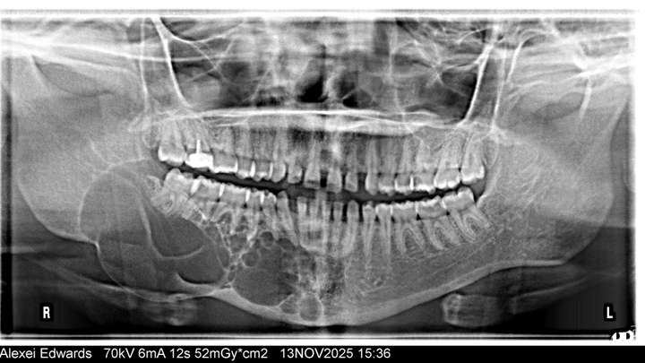 Fundraiser by Samintra Charles : Help Alexei Smile Again: Urgent ...