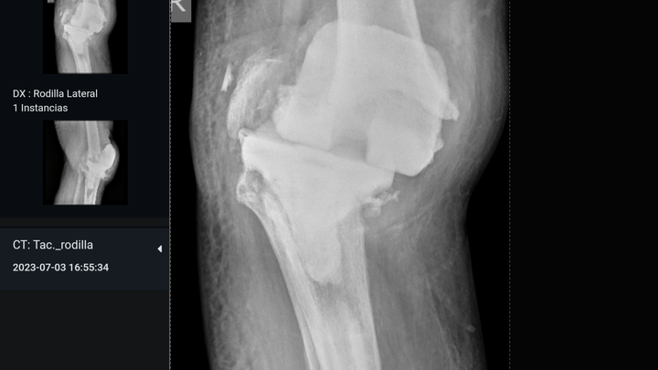 Fundraiser by Andrew Jordan : LAST CHANCE. KNEE operation after failed ...