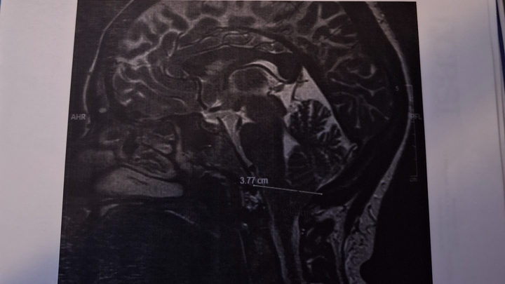 Fundraiser by Jane Kimsey : Support Jane Lee Kimsey's Urgent Brain Surgery