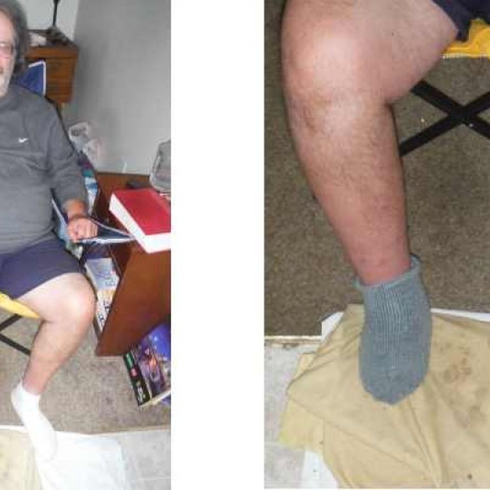 Muscle Atrophy After Cast