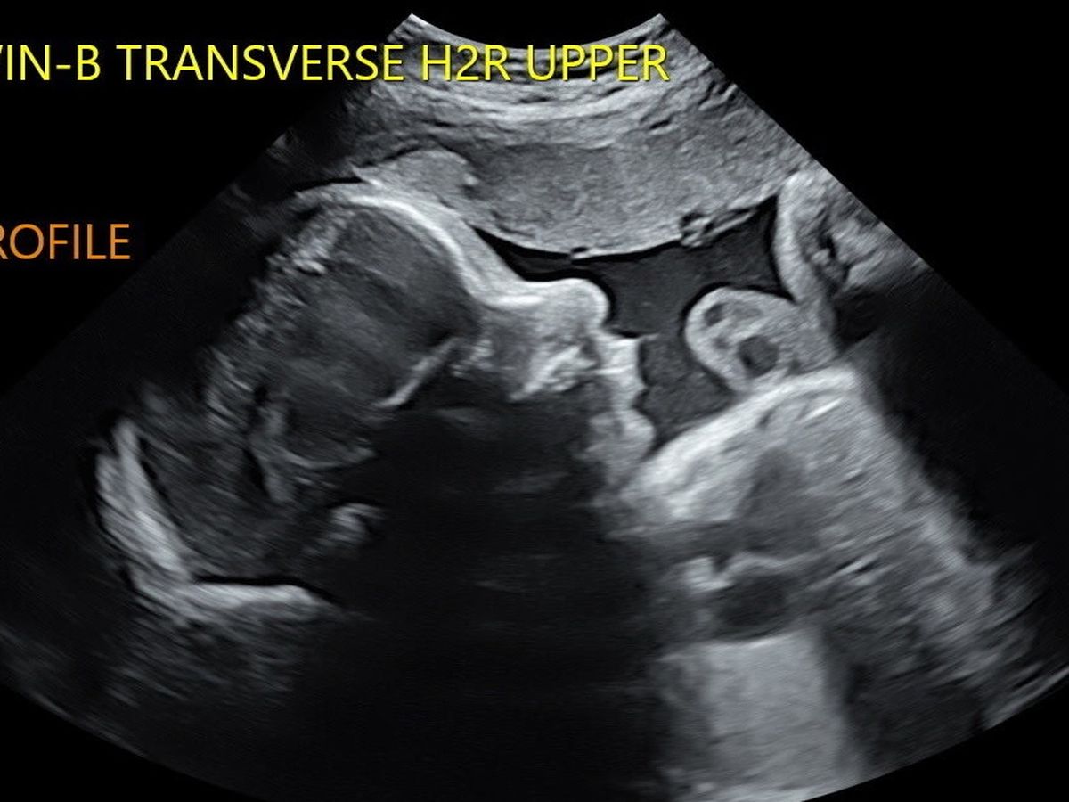 Fundraiser by Kobe Myers : Support for High-Risk Pregnancy & NICU Stay