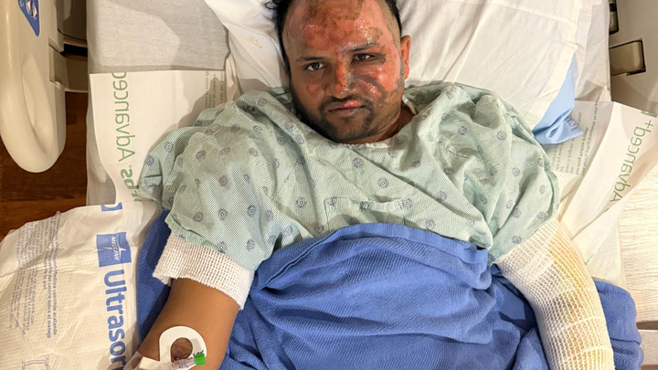 Fundraiser by Deepak Kumar D : Help Overcome Severe Burn Injuries