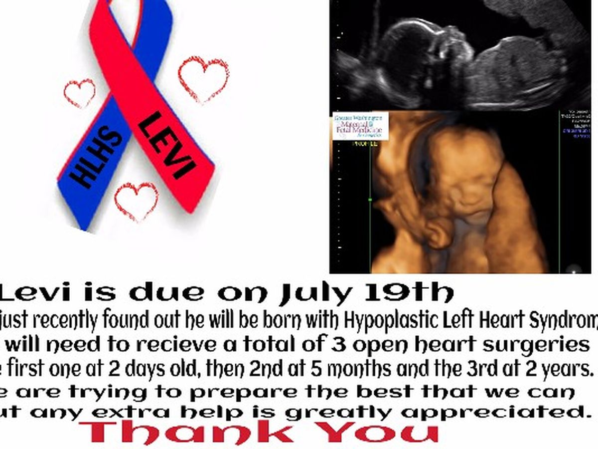 Hypoplastic Left Heart Syndrome Ribbon