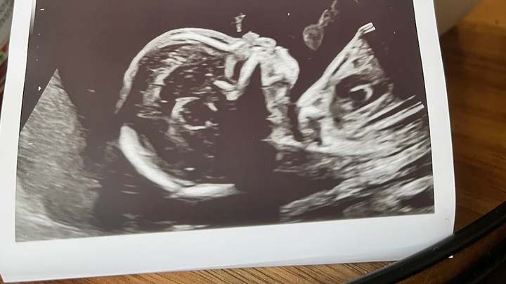 Fundraiser for Sam Bish by Abrielle Ackerman : Our Little Warrior ...