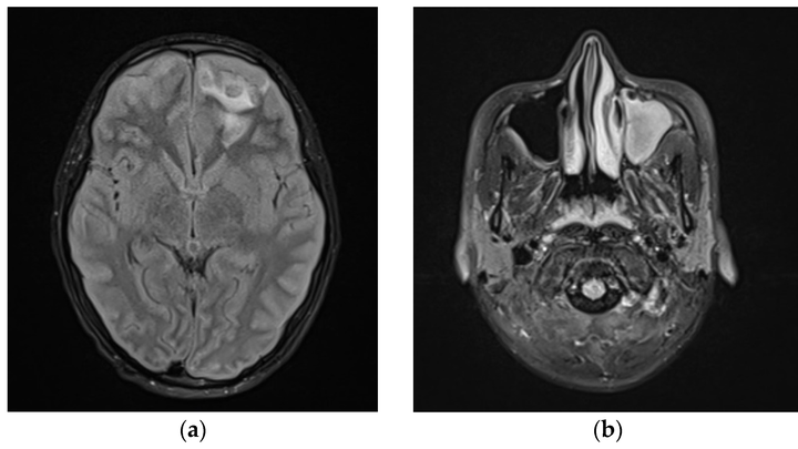 Spendenkampagne von Jeremy Pye: Please Help 15 Year Old Undergoing ...